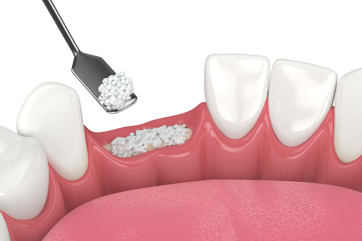 Bone Grafting for Implants in Lone Tree, CO | Rocky Mountain Surgical Arts