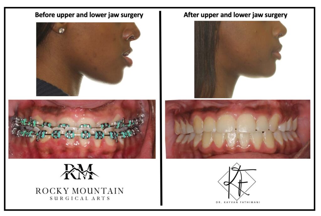 What should I expect after Corrective Jaw Surgery? - Rocky Mountain ...