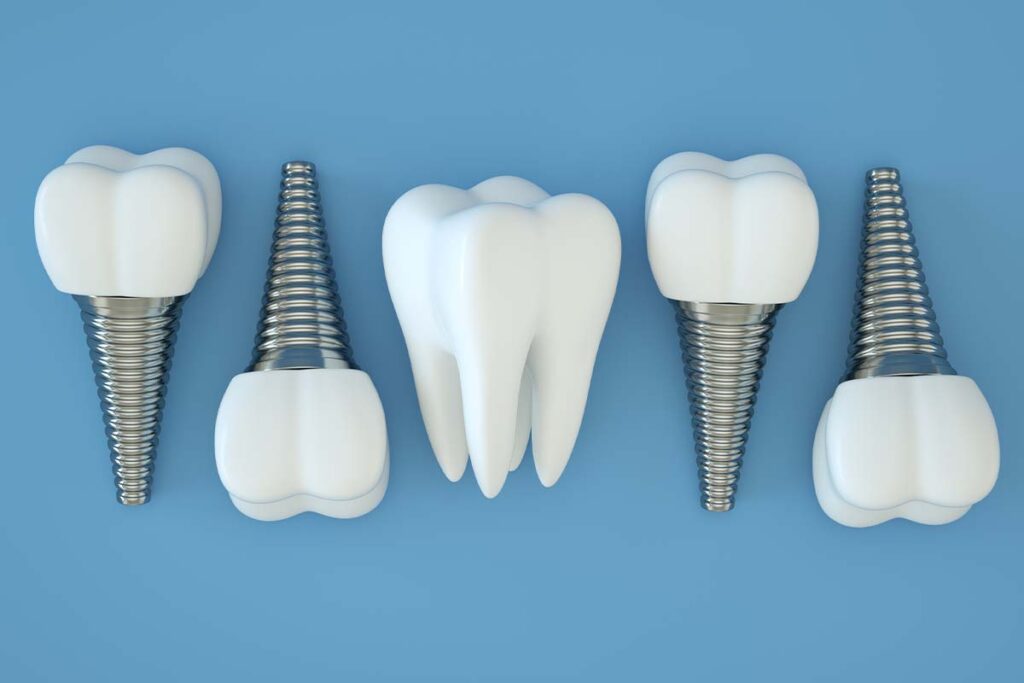 Dental Implants in Lone Tree, CO | Rocky Mountain Surgical Arts