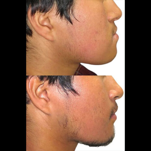 Orthognathic Surgery | Corrective Jaw Surgery in Denver, CO