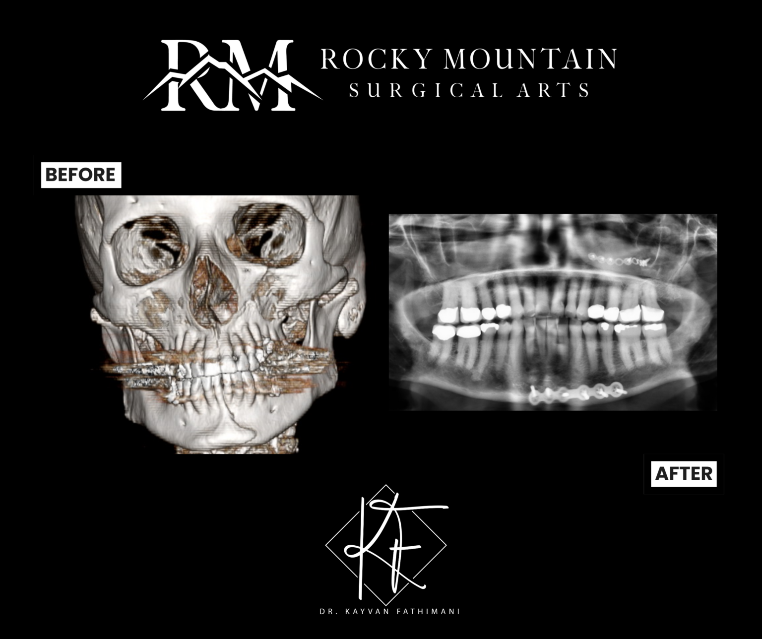 Facial Trauma Surgery in Lone Tree, CO | Rocky Mountain Surgical Arts