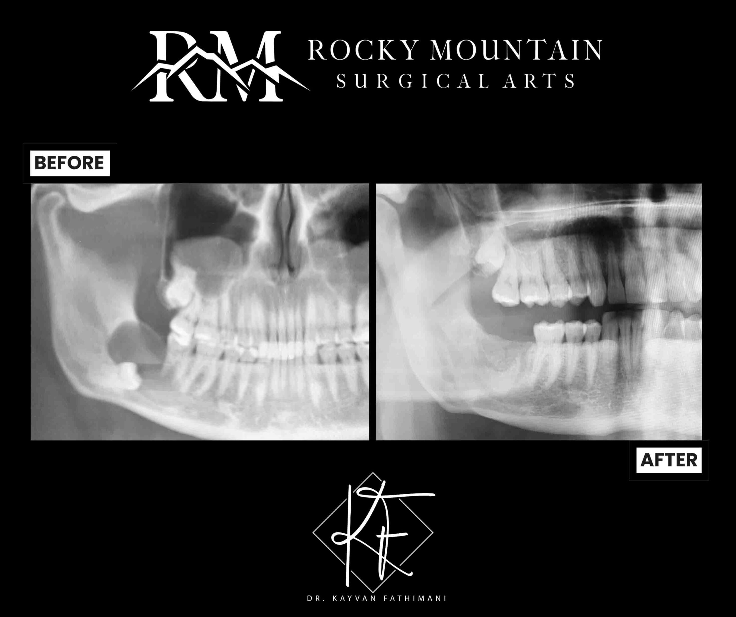 Oral Pathology in Lone Tree, CO | Rocky Mountain Surgical Arts