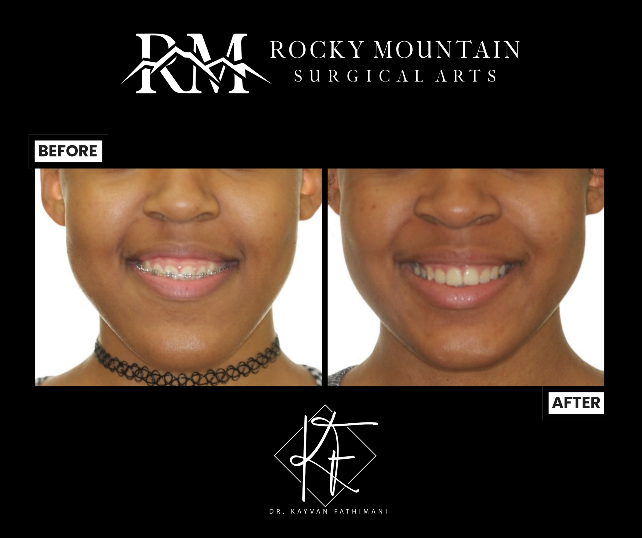 Orthognathic Surgery in Denver, CO | Corrective Jaw Surgery | RMSA