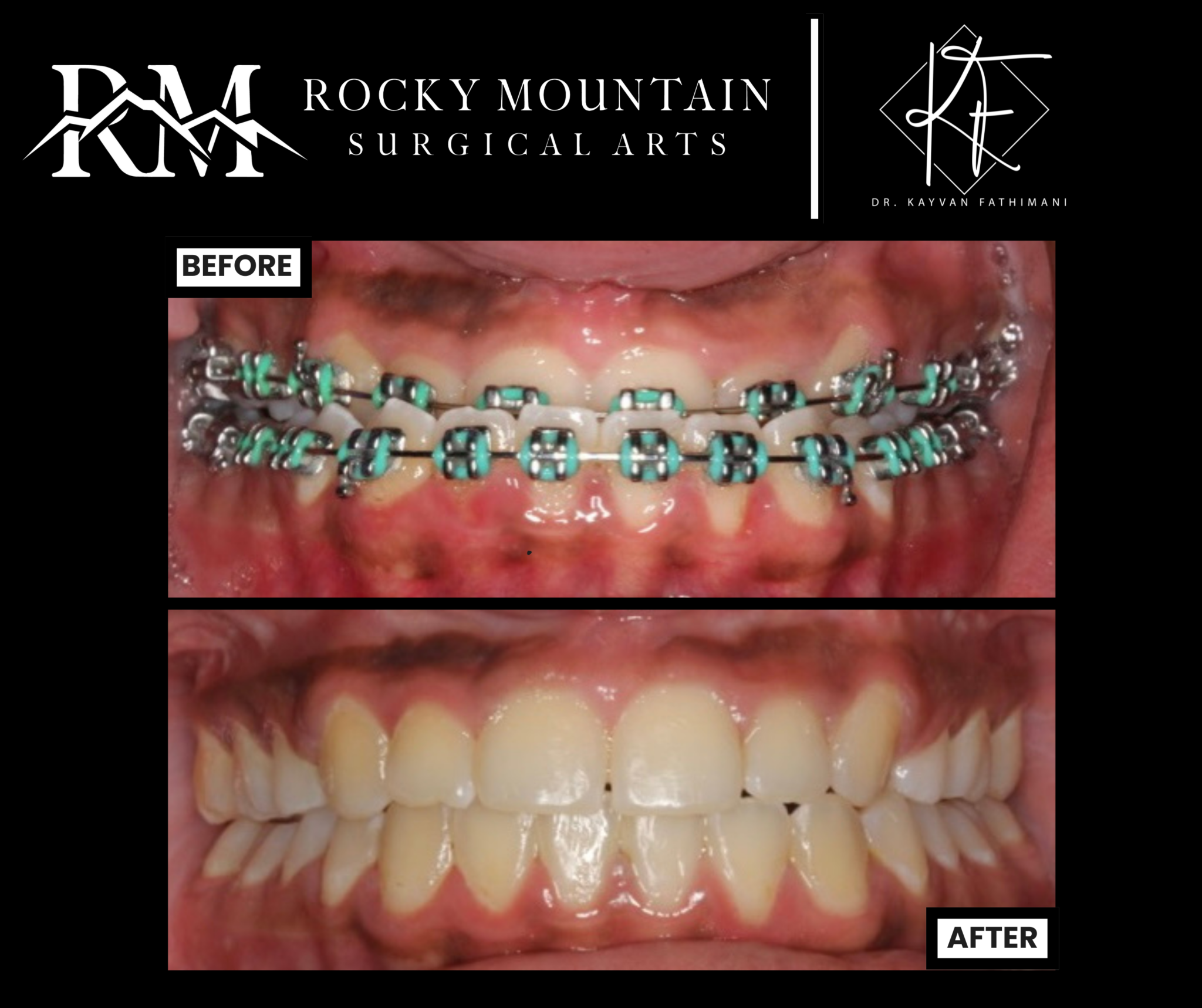 Orthognathic Surgery in Denver, CO | Corrective Jaw Surgery | RMSA