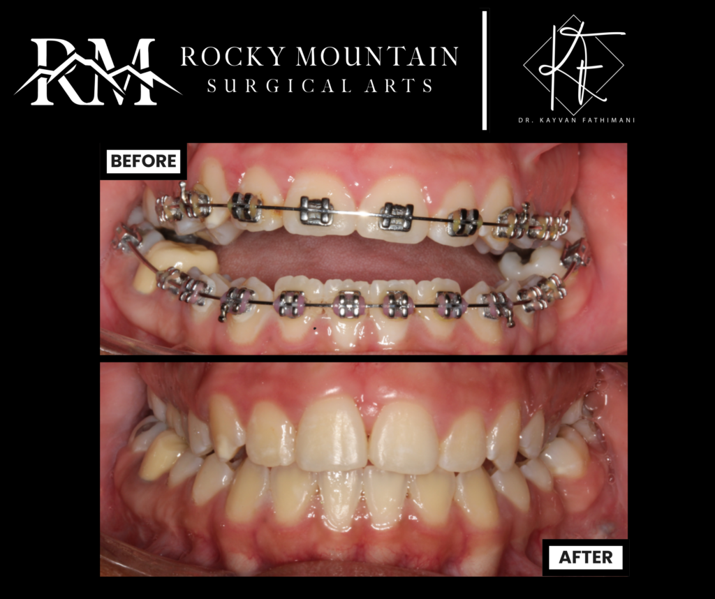 Orthognathic Surgery in Denver, CO | Corrective Jaw Surgery | RMSA