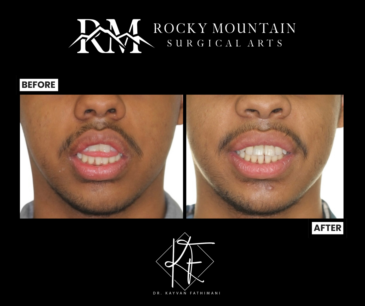 Orthognathic Surgery in Denver, CO | Corrective Jaw Surgery | RMSA