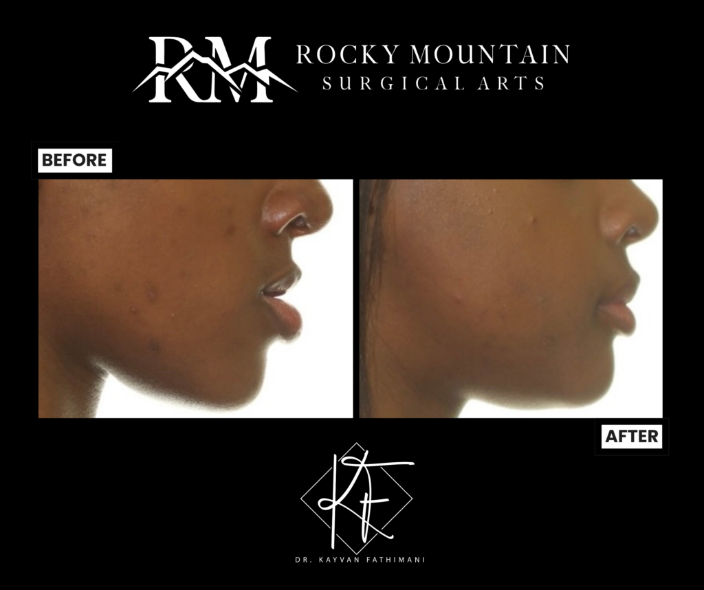 Orthognathic Surgery in Denver, CO | Corrective Jaw Surgery | RMSA