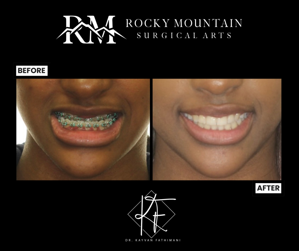 Orthognathic Surgery in Denver, CO | Corrective Jaw Surgery | RMSA