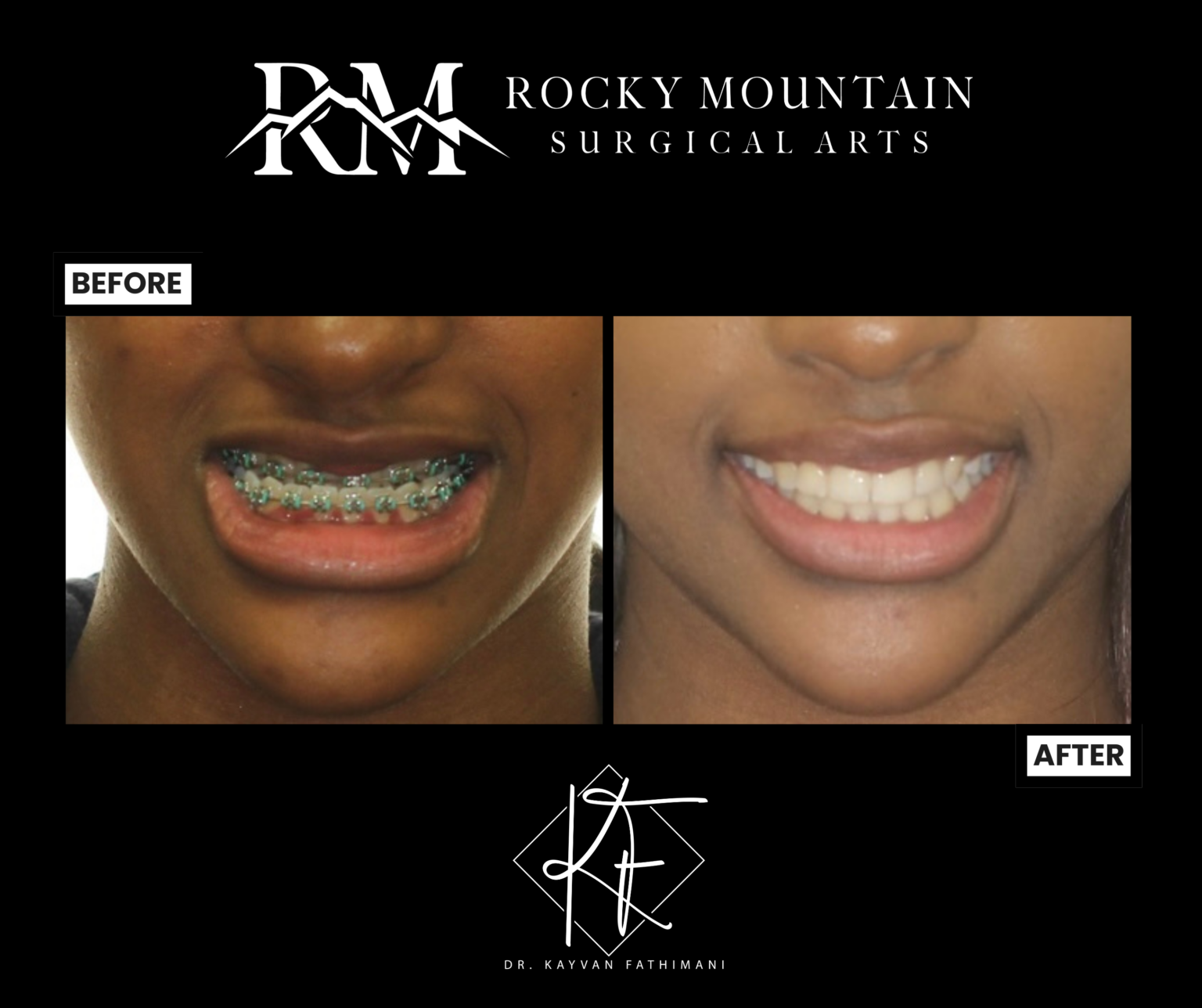 Orthognathic Surgery in Denver, CO | Corrective Jaw Surgery | RMSA