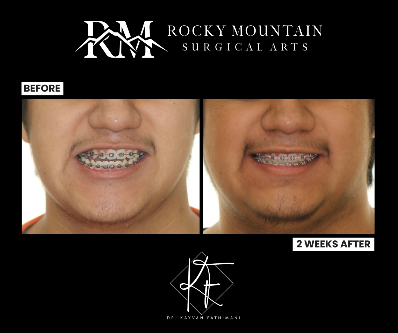 Orthognathic Surgery in Denver, CO | Corrective Jaw Surgery | RMSA
