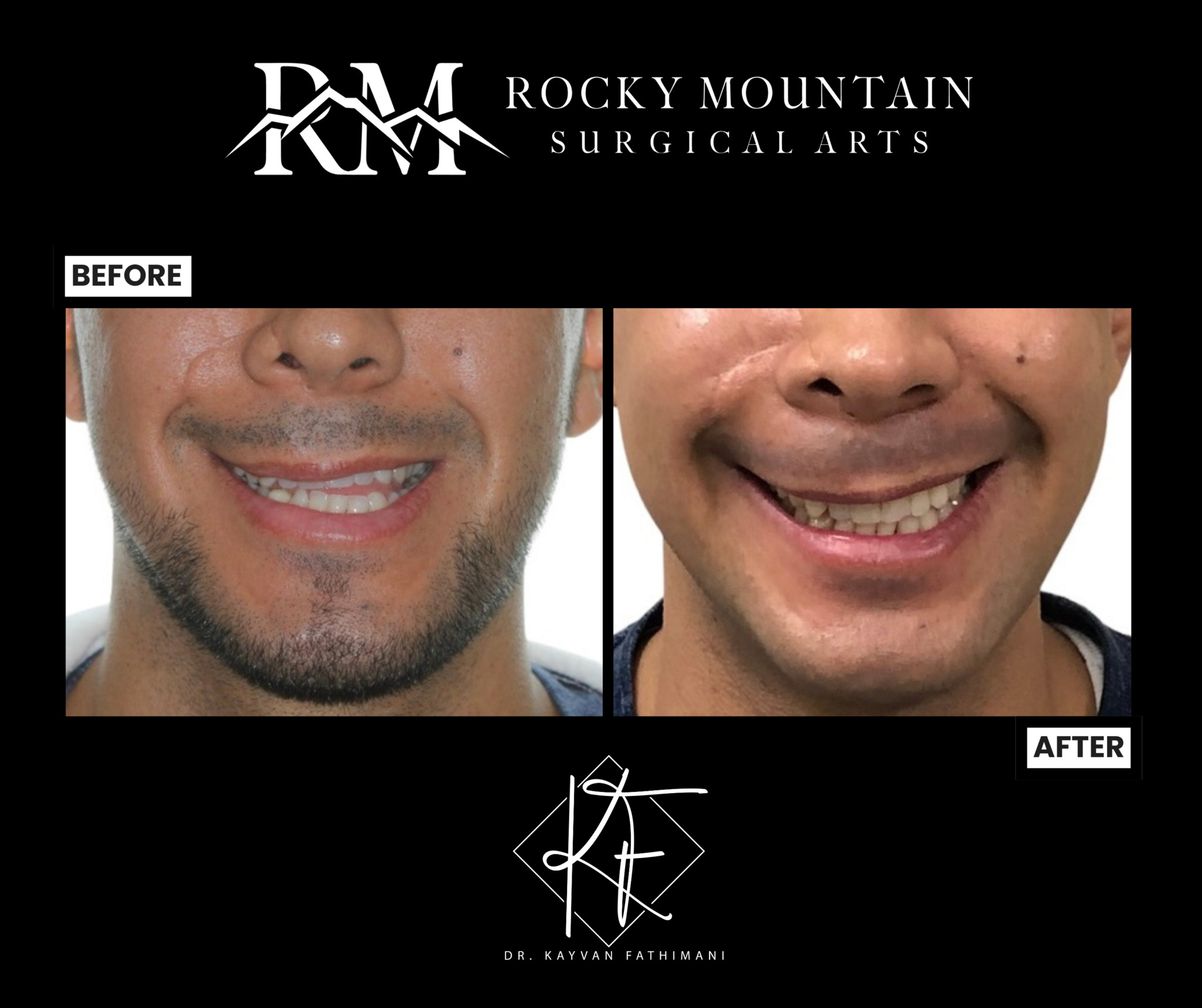 Orthognathic Surgery in Denver, CO | Corrective Jaw Surgery | RMSA