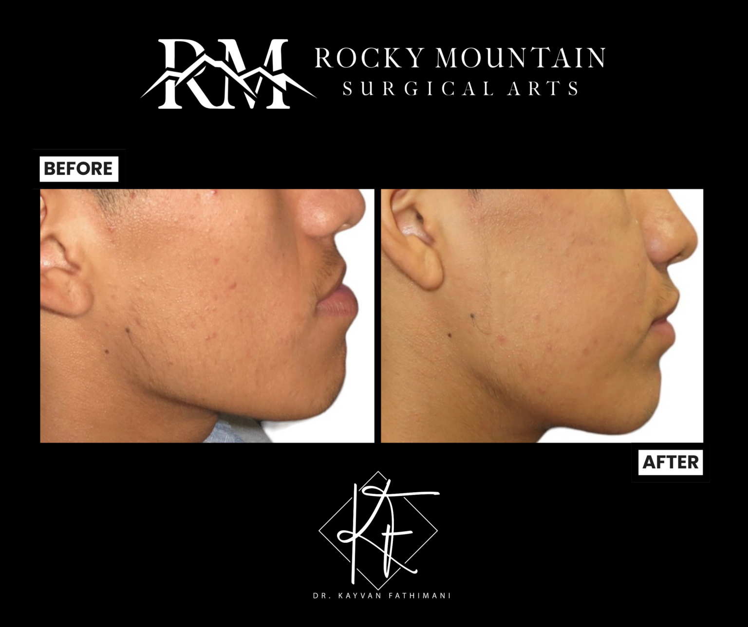 Orthognathic Surgery in Denver, CO | Corrective Jaw Surgery | RMSA