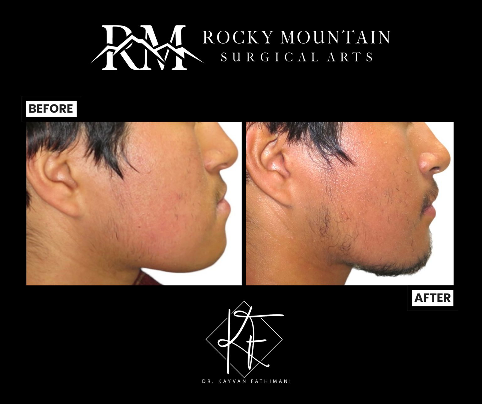 Orthognathic Surgery in Denver, CO | Corrective Jaw Surgery | RMSA