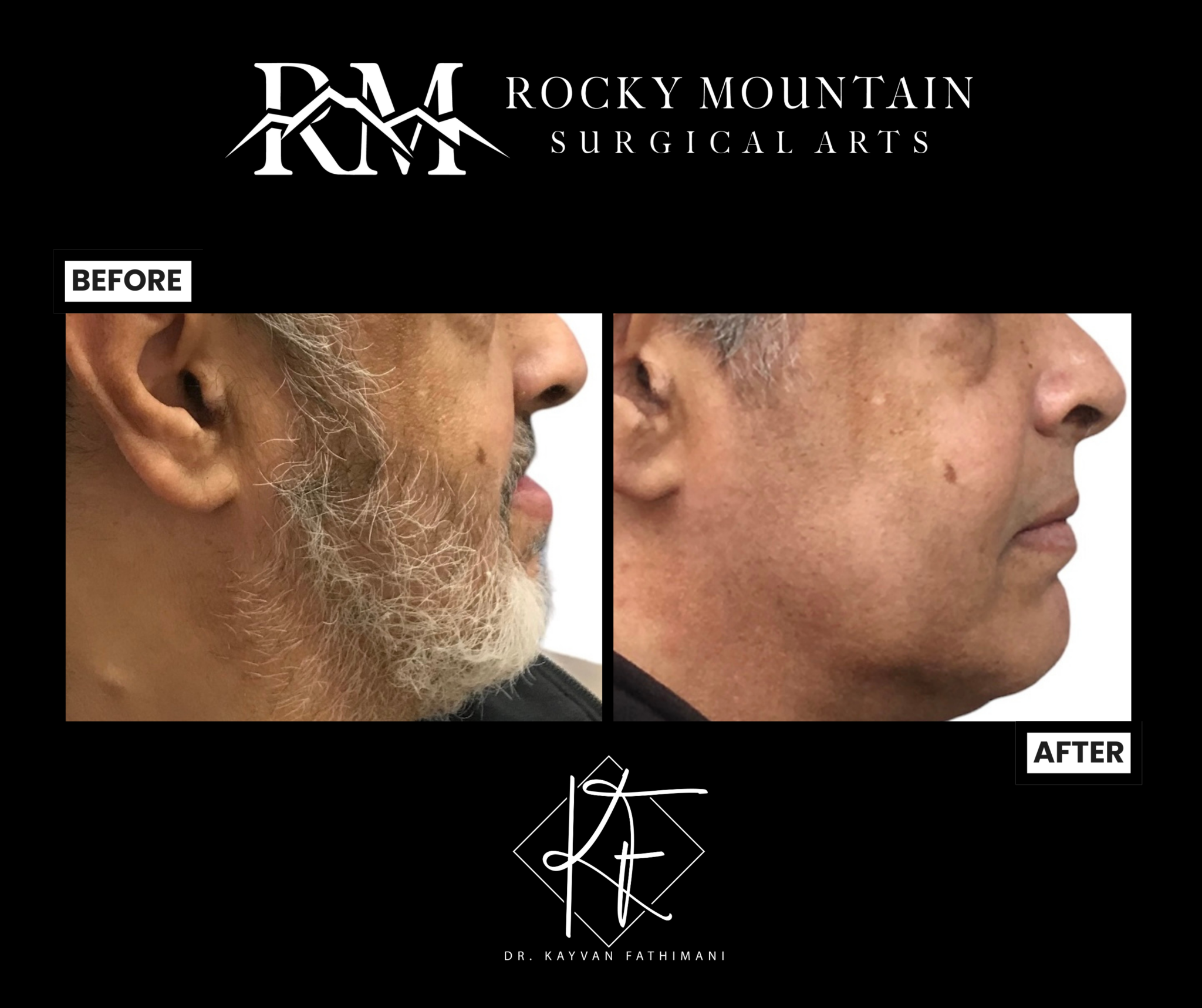 Orthognathic Surgery in Denver, CO | Corrective Jaw Surgery | RMSA