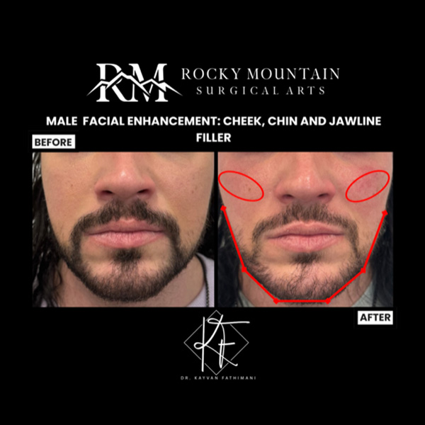 Mastering Masculine Contours: Male Facial Enhancement with Bellafill or ...