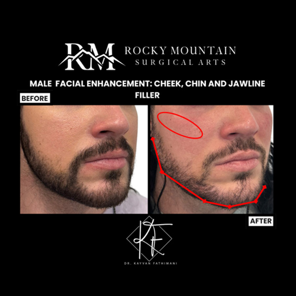 Mastering Masculine Contours: Male Facial Enhancement with Bellafill or ...