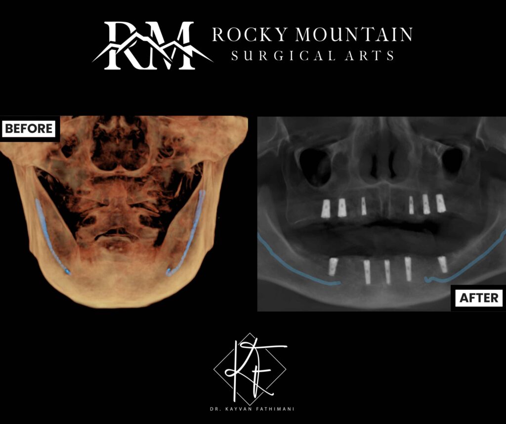 Dental Implants in Lone Tree, CO | Rocky Mountain Surgical Arts