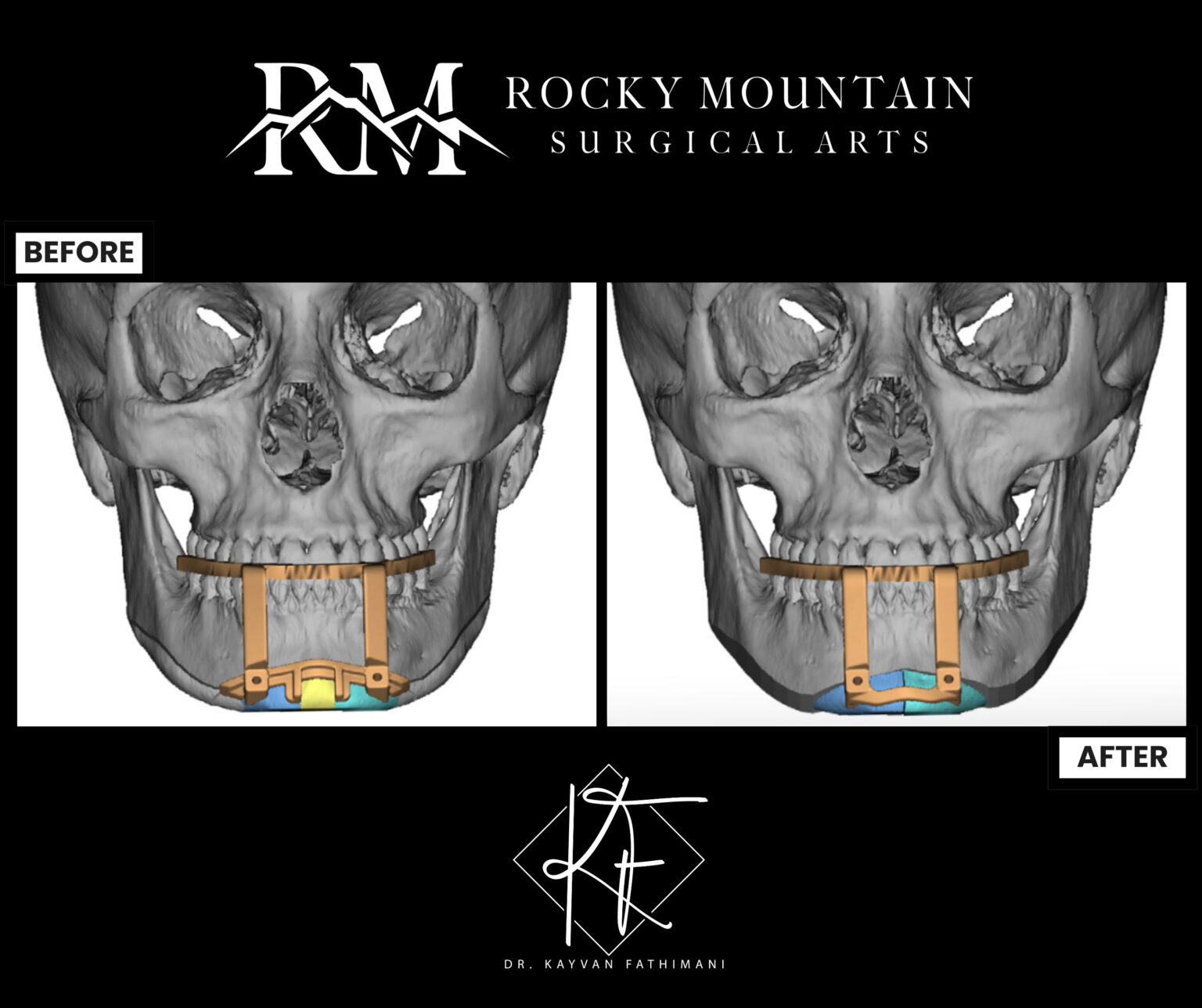 V-Line Surgery in Lone Tree, CO | Rocky Mountain Surgical Arts