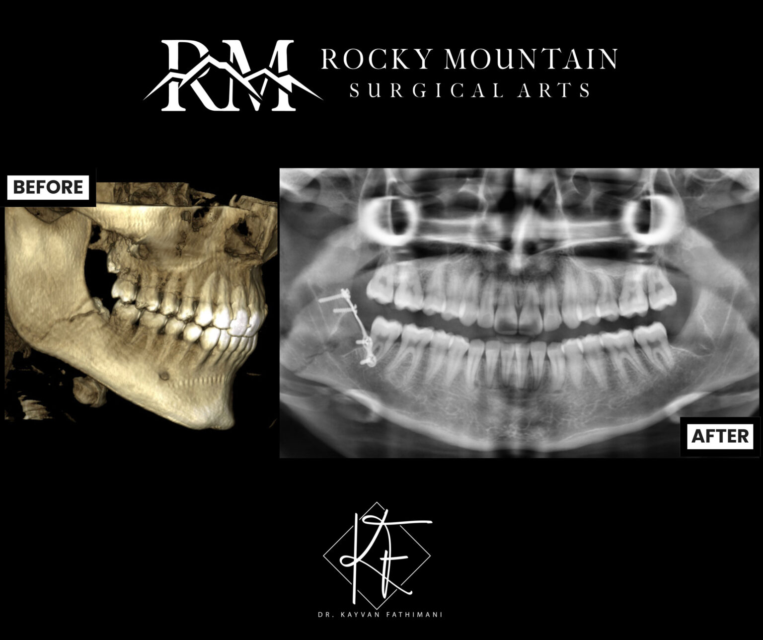 Facial Trauma Surgery in Lone Tree, CO | Rocky Mountain Surgical Arts