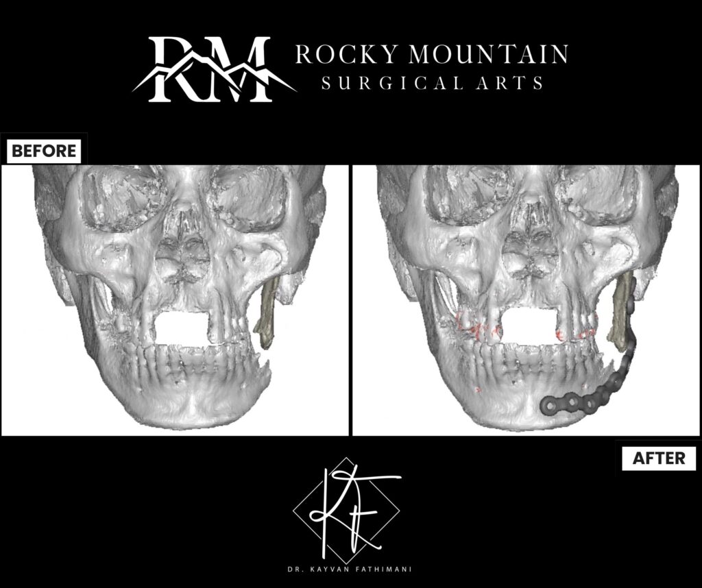 Facial Trauma Surgery in Lone Tree, CO | Rocky Mountain Surgical Arts