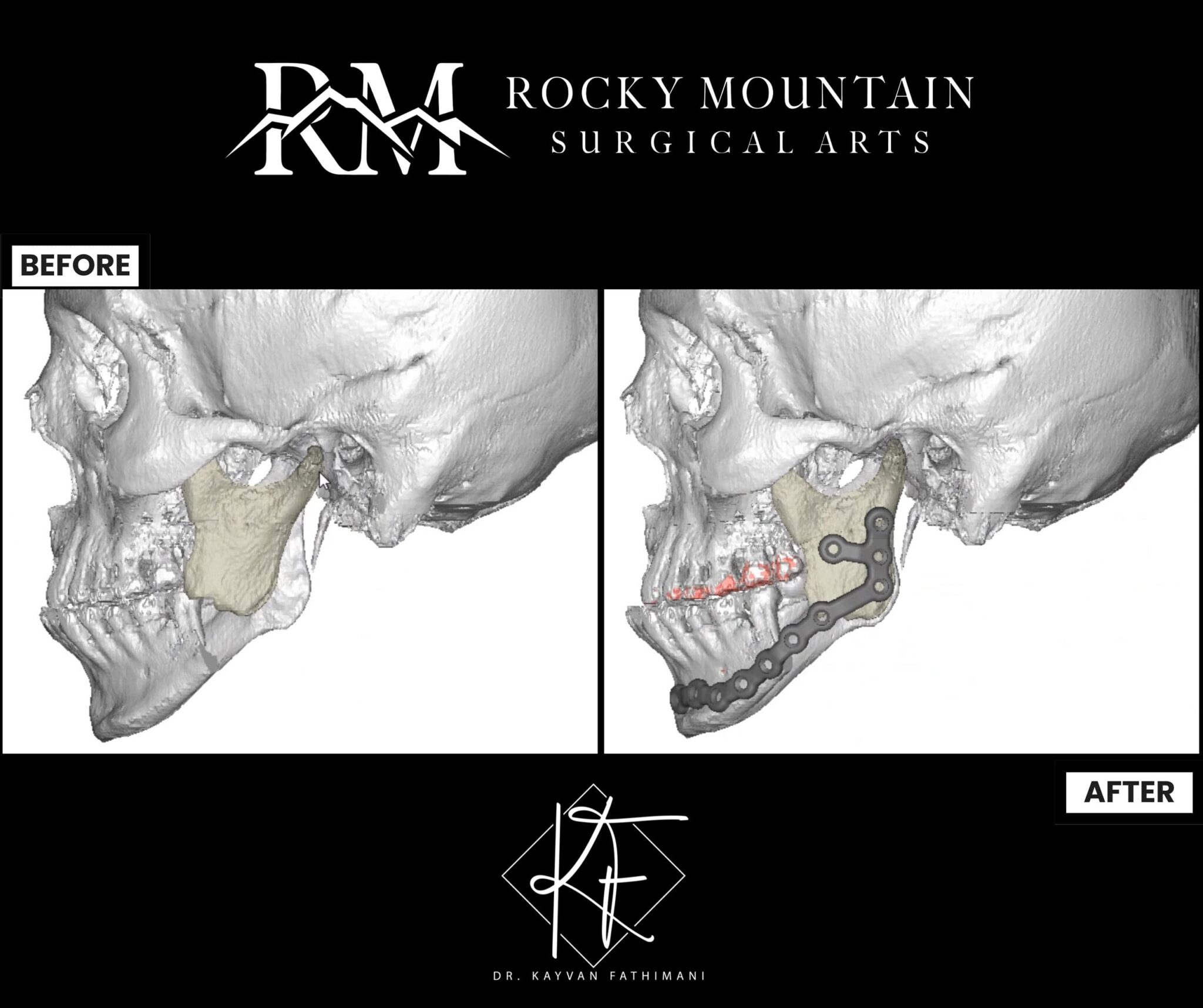 Facial Trauma Surgery in Lone Tree, CO | Rocky Mountain Surgical Arts