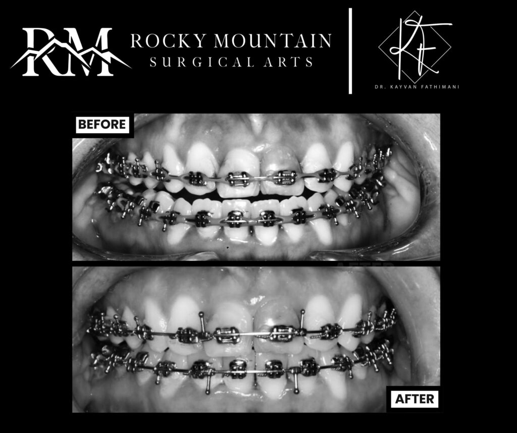 Lower Jaw Surgery in Denver & Lone Tree, CO | Rocky Mountain Surgical Arts