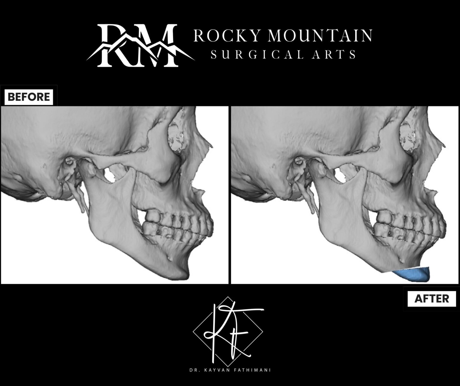 Genioplasty in Denver, CO | Rocky Mountain Surgical Arts