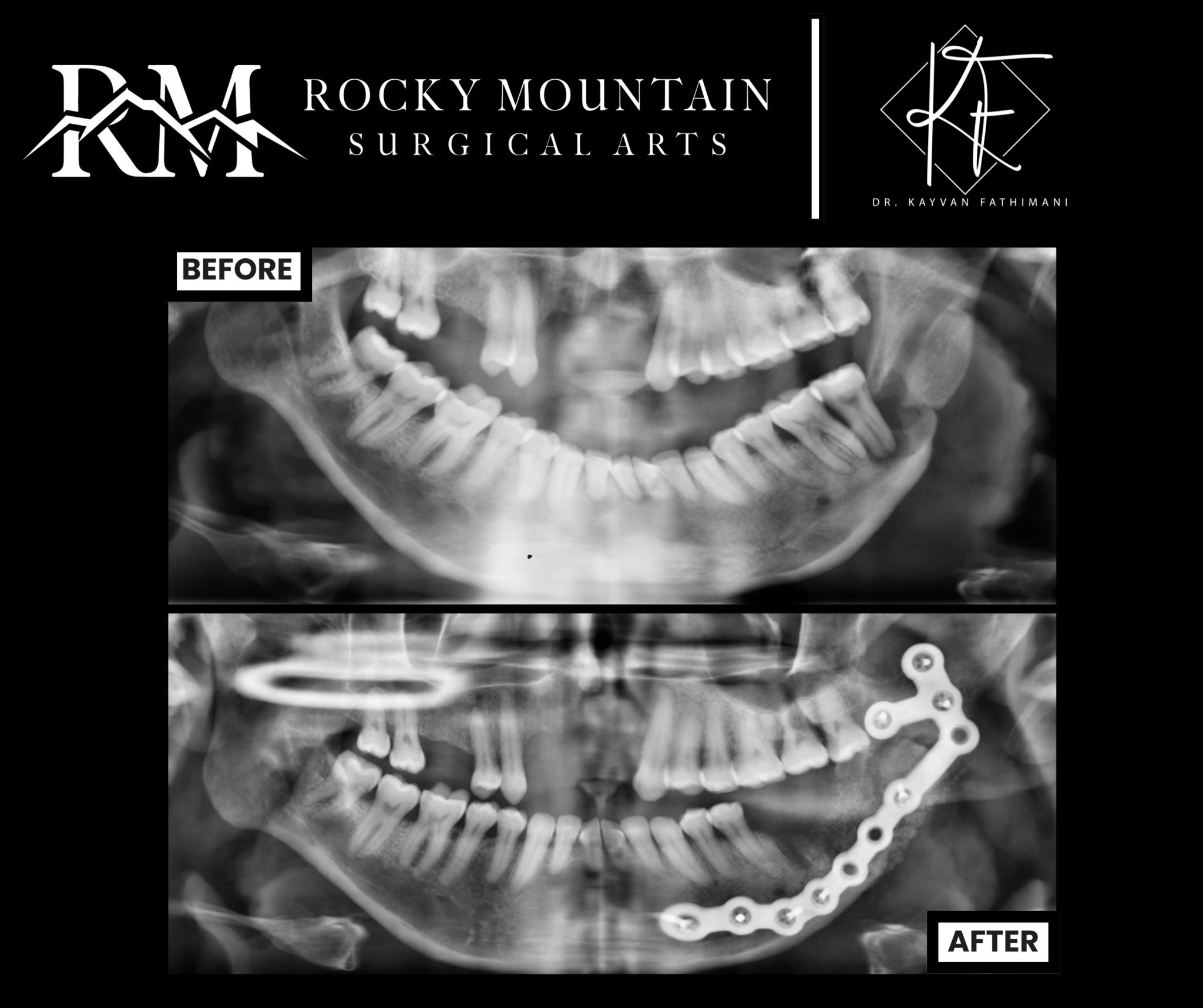 Facial Trauma Surgery in Lone Tree, CO | Rocky Mountain Surgical Arts