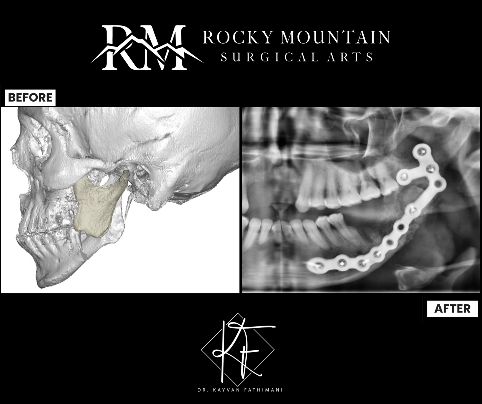 Facial Trauma Surgery in Lone Tree, CO | Rocky Mountain Surgical Arts