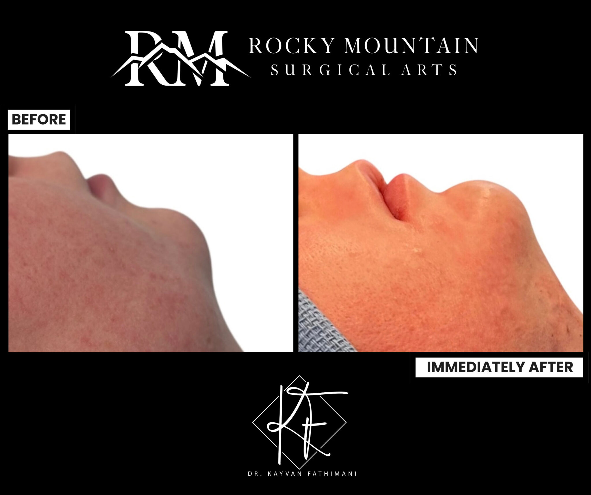 Genioplasty in Denver, CO | Rocky Mountain Surgical Arts